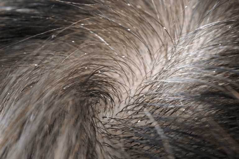 Lice Vs Dandruff A Complete Guide Bullocks Buzz