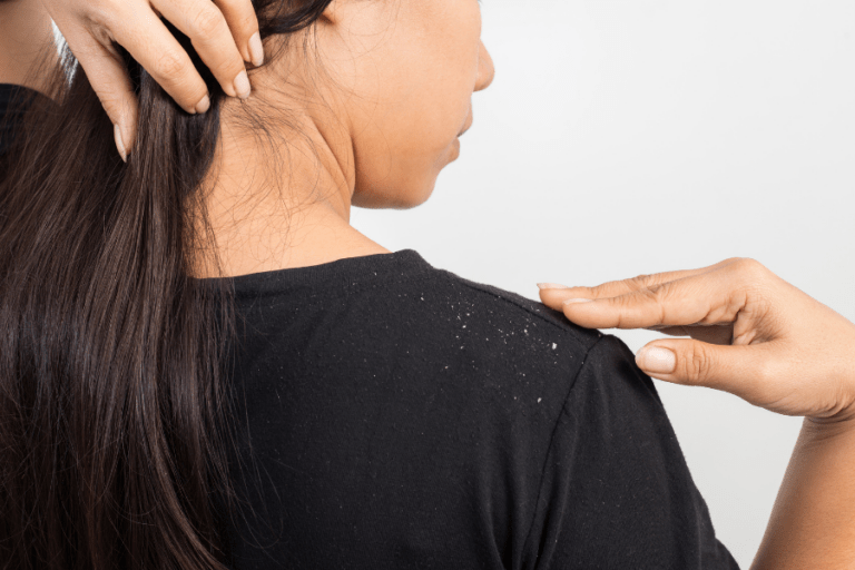 Lice vs. Dandruff - A Complete Guide - Bullock's Buzz